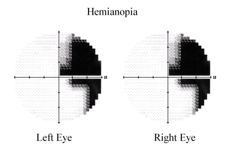 Eye-Search - UCL's free therapy for visual search problems